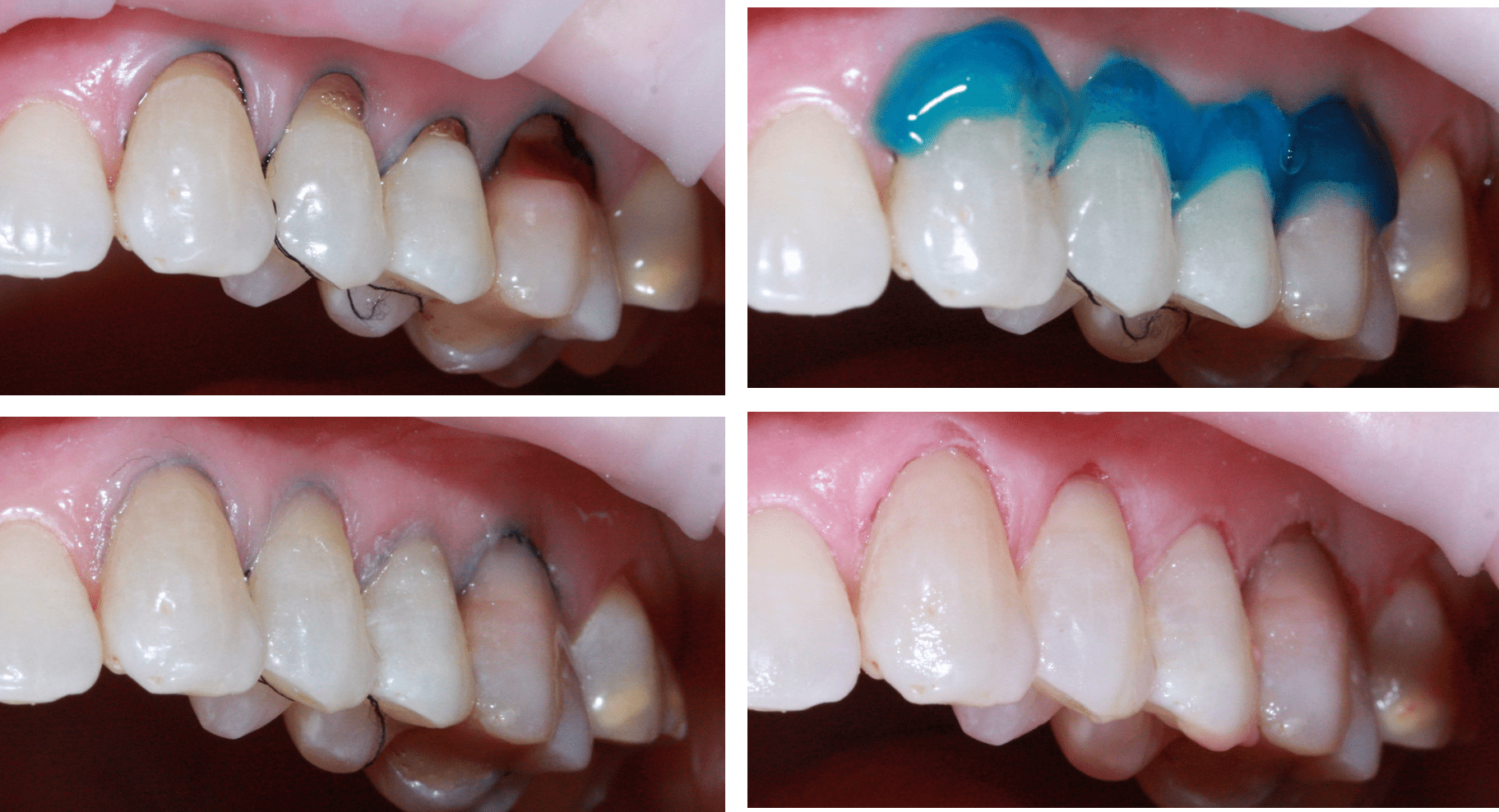 Leziuni necarioase dentare. Defectul cuneiform. - e-medicina.md