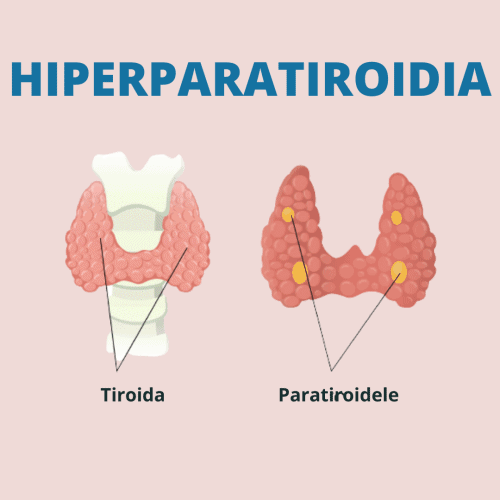 HIPERPARATIROIDIA - manifestari, diagnostic, tratament - e-medicina.md