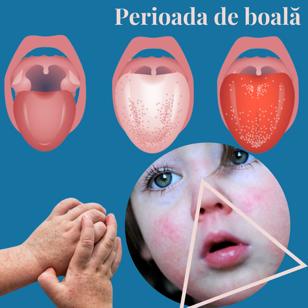 Scarlatina - e-medicina.md