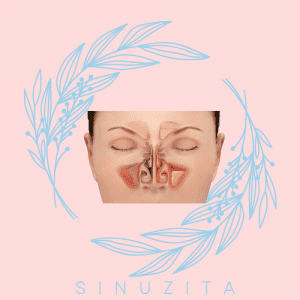 Sinuzita - cauze, simptome, tratament - e-medicina.md
