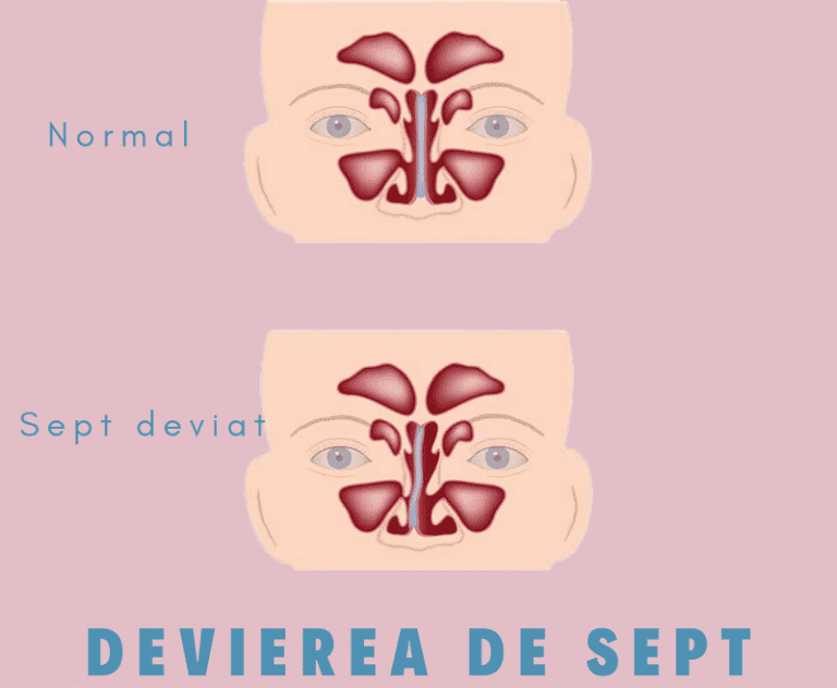 Devierea septului nazal - e-medicina.md