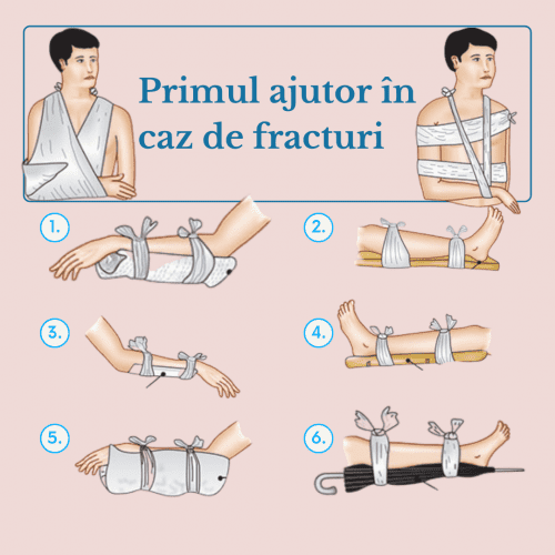 Primul ajutor în caz de fractură - e-medicina.md