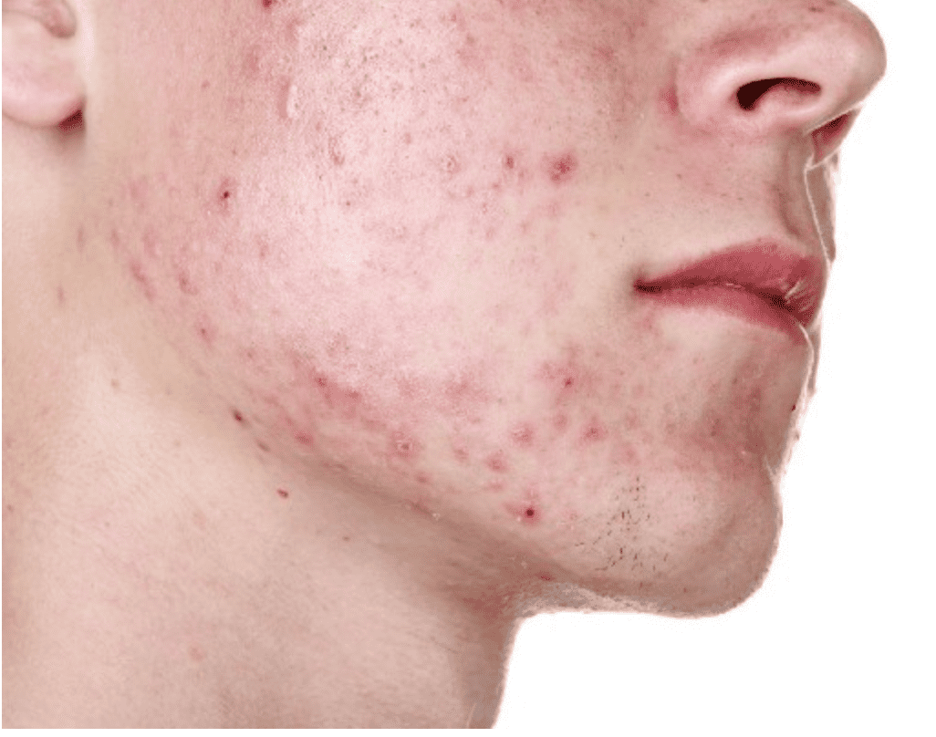 Bubite și umflături sub piele - e-medicina.md